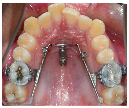 Distalization Methods for Maxillary Molars Utilizing Temporary Anchorage Devices (TADs): A ...