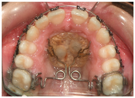 Distalization Methods for Maxillary Molars Utilizing Temporary ...