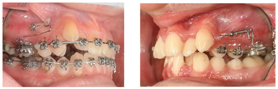 Distalization Methods for Maxillary Molars Utilizing Temporary ...
