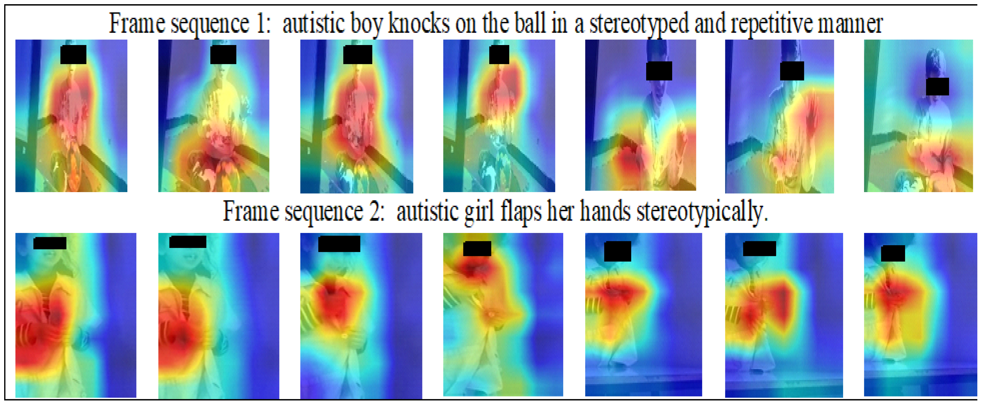 Hybrid 3D Convolutional–Transformer Model for Detecting Stereotypical ...