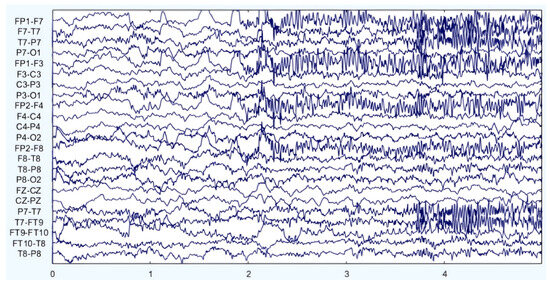 Epilepsy EEG Seizure Prediction Based on the Combination of Graph ...