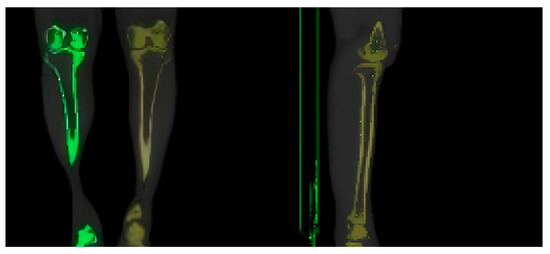Biomechanical and Injury Tolerance Analysis of Tibial Movement Under ...