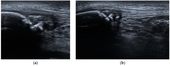 Lower Limb Osteochondrosis and Apophysitis in Young Athletes—A ...