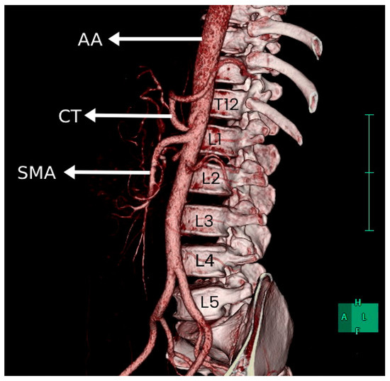 Radiological Study of the Normal and Anatomical Variants of the Celiac ...