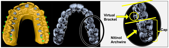 Assessment of Dental Arch Width Expansion Effectiveness Using a Novel ...