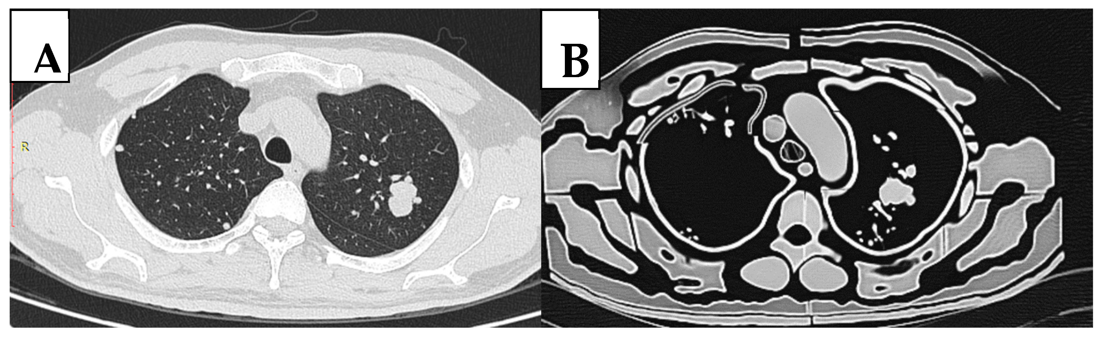 Development of a 3D-Printed Chest Phantom with Simulation of Lung Nodules for Studying Ultra-Low ...