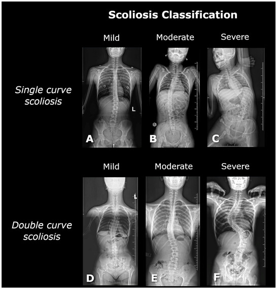 Exploring BiomedCLIP’s Capabilities in Medical Image Analysis: A Focus on Scoliosis Detection ...