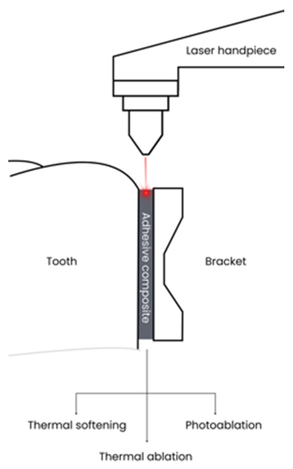 Laser Applications in Metal Orthodontic Bracket Debonding: A Systematic ...