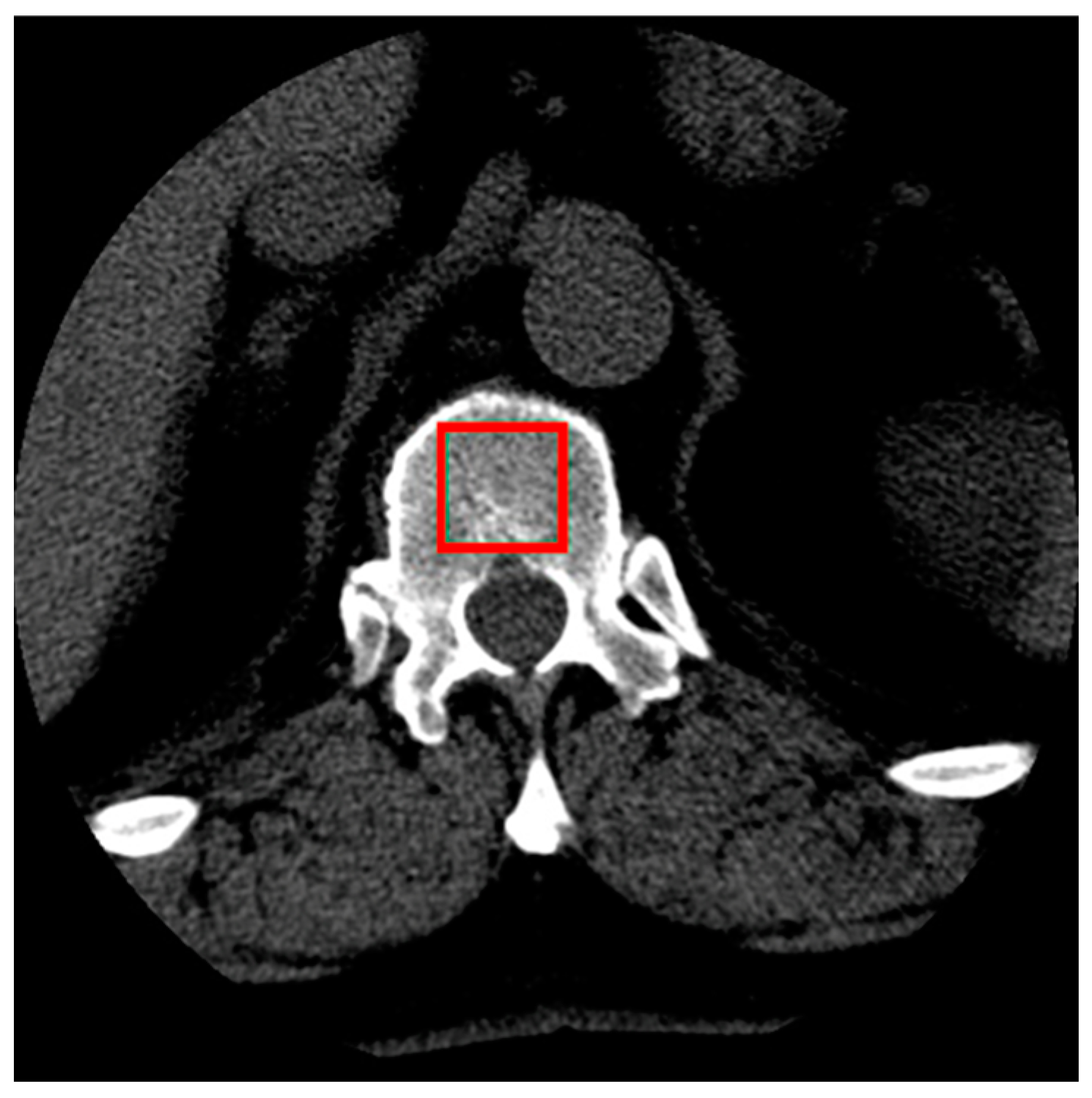 Impact of Texture Feature Count on the Accuracy of Osteoporotic Change ...