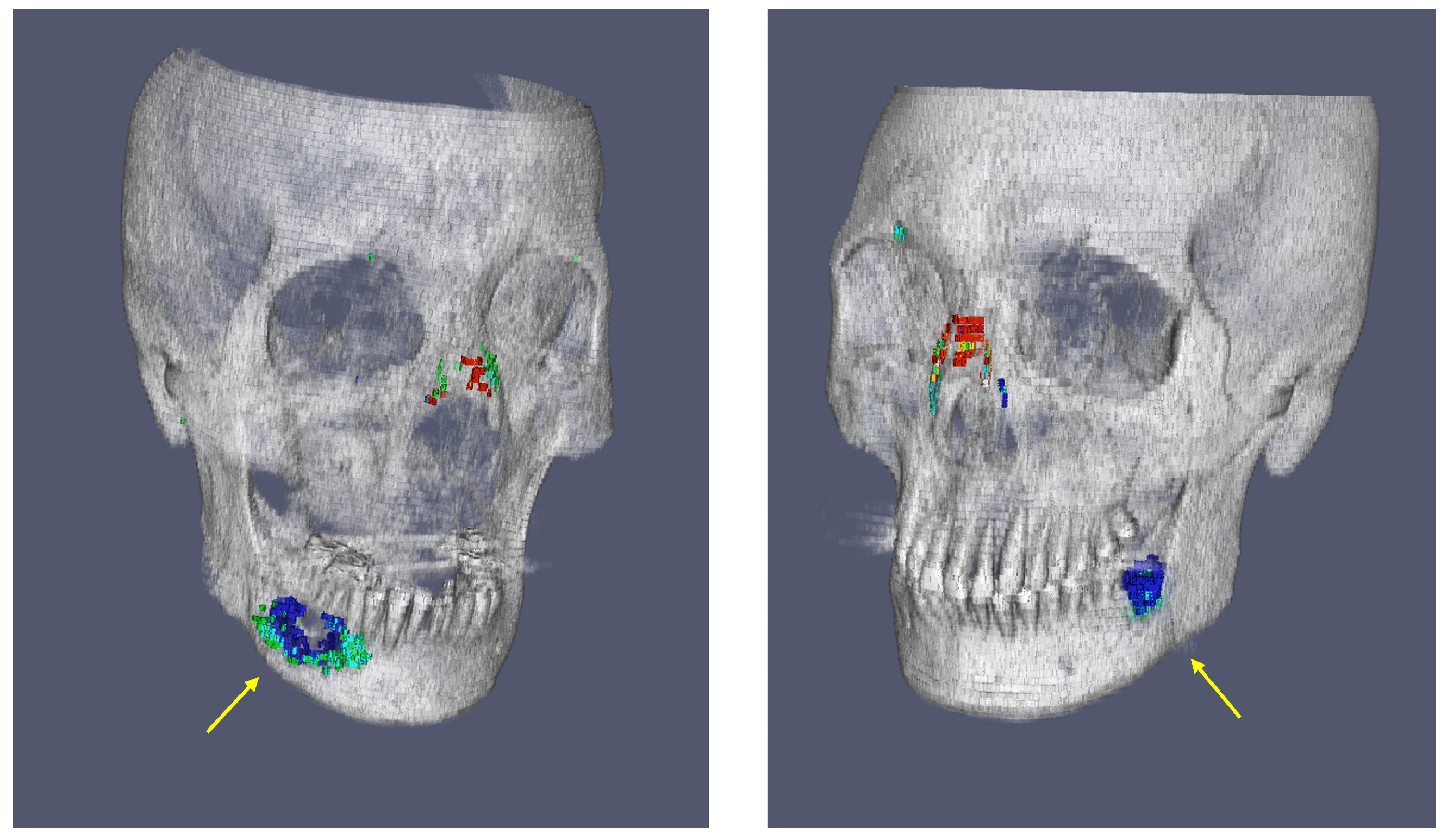 A Refined Approach to Segmenting and Quantifying Inter-Fracture Spaces ...
