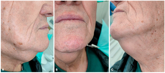 Submental Abscess Following Peri-Implantitis: Case Report and ...