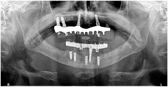 Submental Abscess Following Peri-Implantitis: Case Report and ...