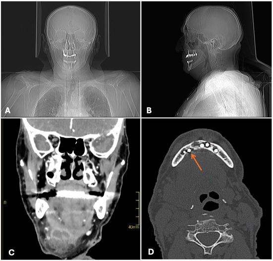 Submental Abscess Following Peri-Implantitis: Case Report and ...