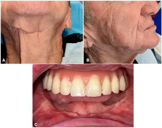 Submental Abscess Following Peri-Implantitis: Case Report and ...