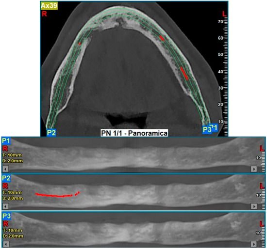 Submental Abscess Following Peri-Implantitis: Case Report and ...