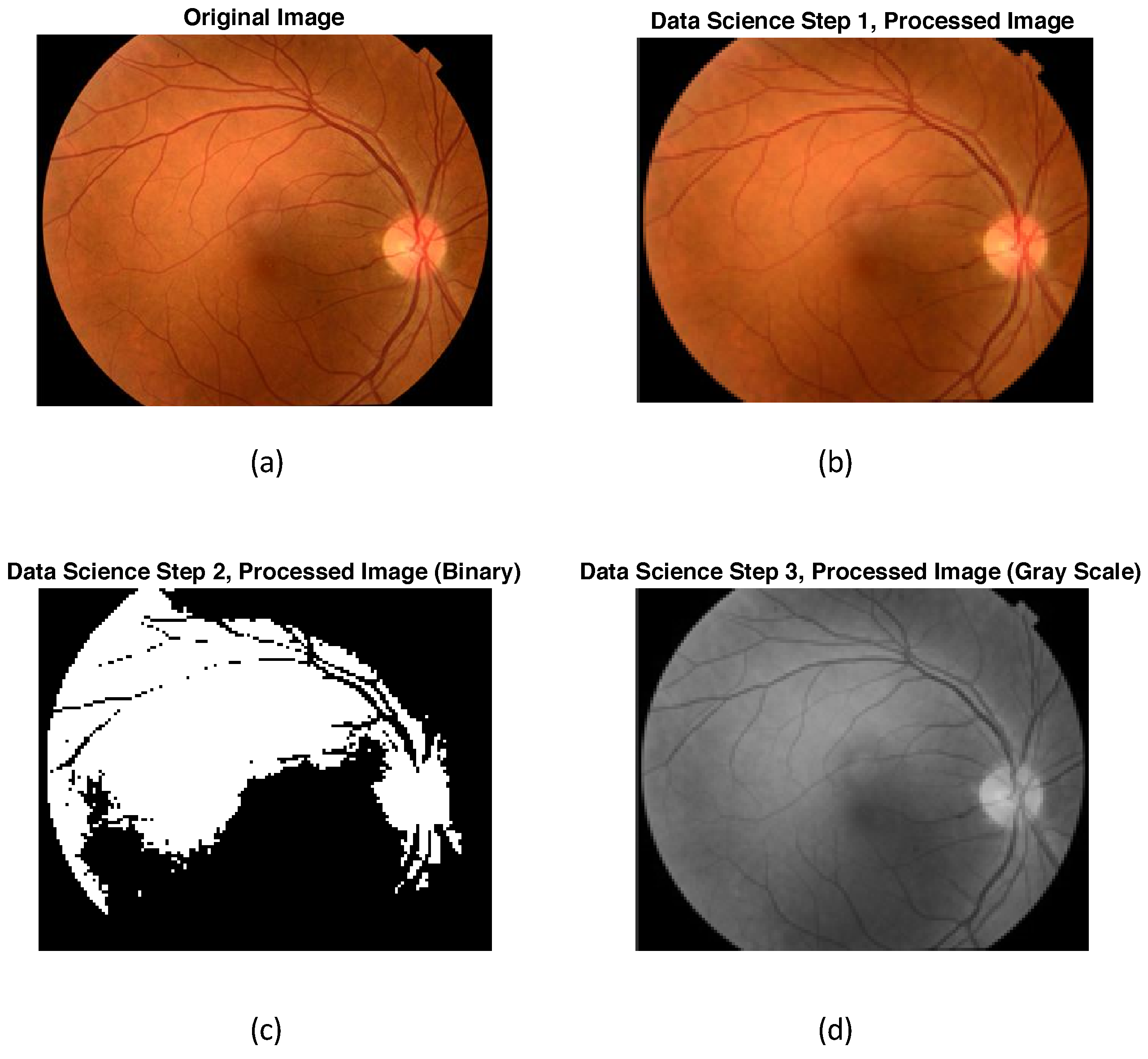 From Pixels to Diagnosis: Early Detection of Diabetic Retinopathy Using ...