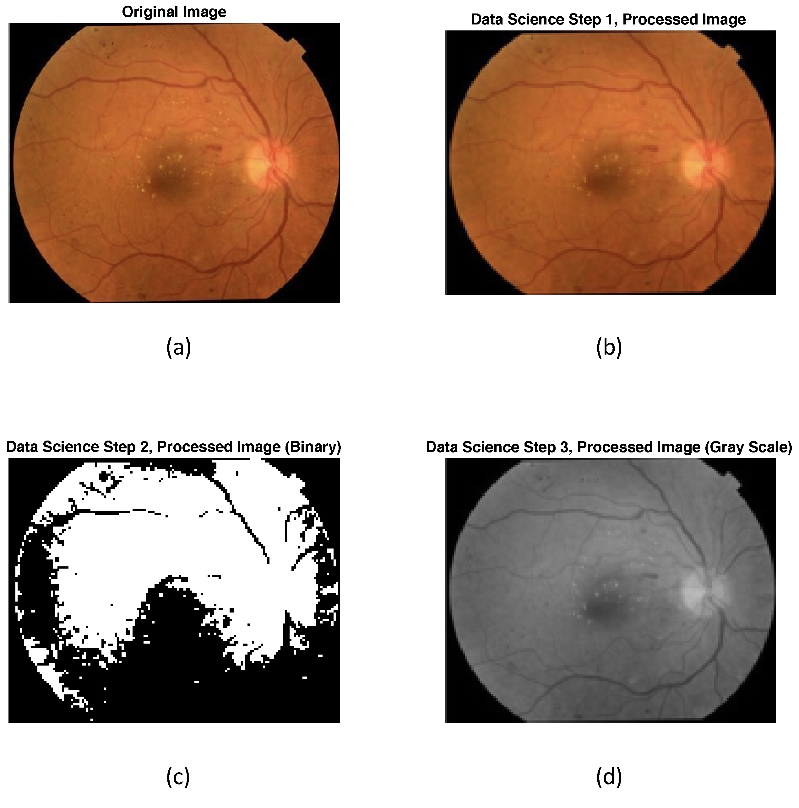 From Pixels to Diagnosis: Early Detection of Diabetic Retinopathy Using ...
