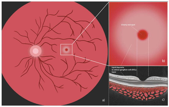 Sphingolipidoses and Retinal Involvement: A Comprehensive Review