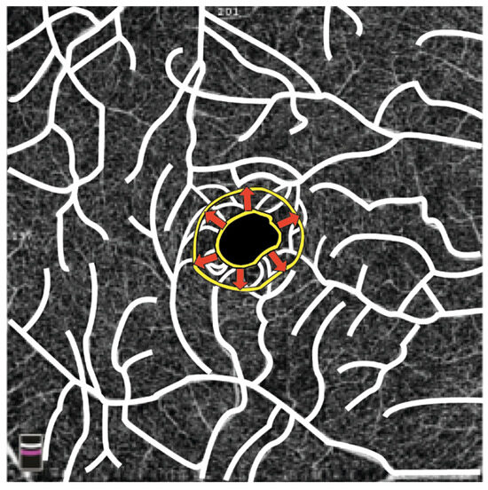 Sphingolipidoses and Retinal Involvement: A Comprehensive Review