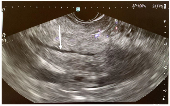 Role of Endoscopic Ultrasound in Diagnosis and Management of Pancreas ...