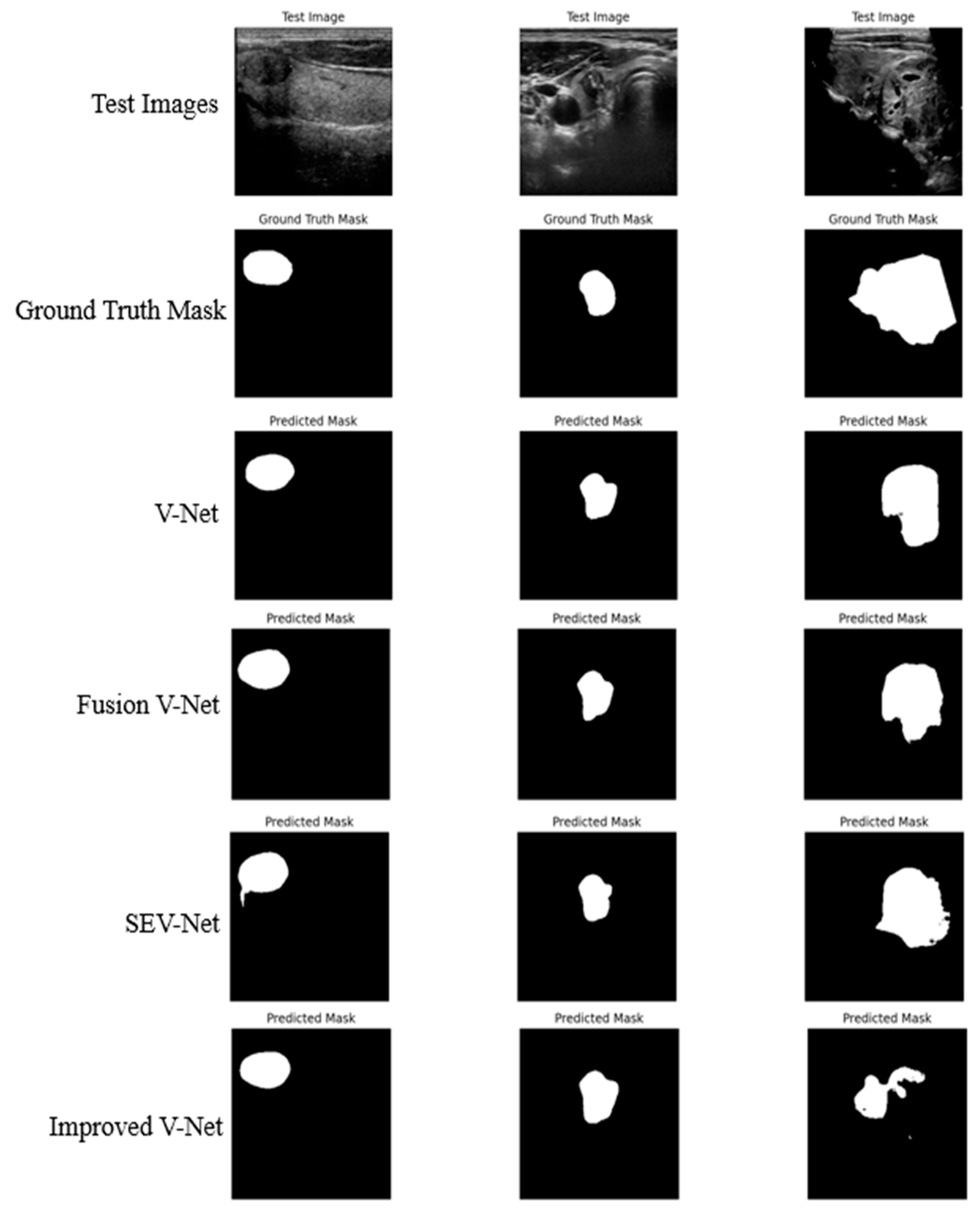 An Improved V-Net Model for Thyroid Nodule Segmentation