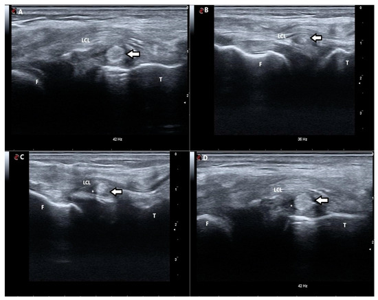A Sonographic Examination of the Iliotibial Band Strip Used in the Mini ...