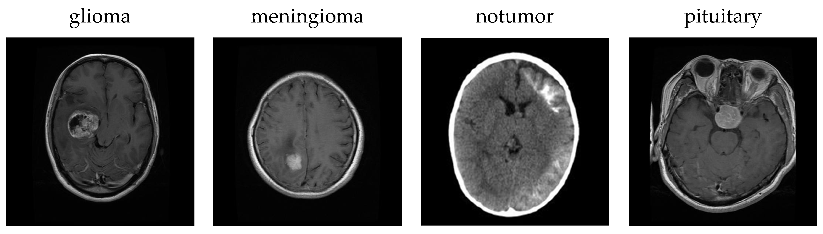A Novel Hybrid Deep Learning Model Enhanced with Explainable AI for Brain Tumor Multi ...