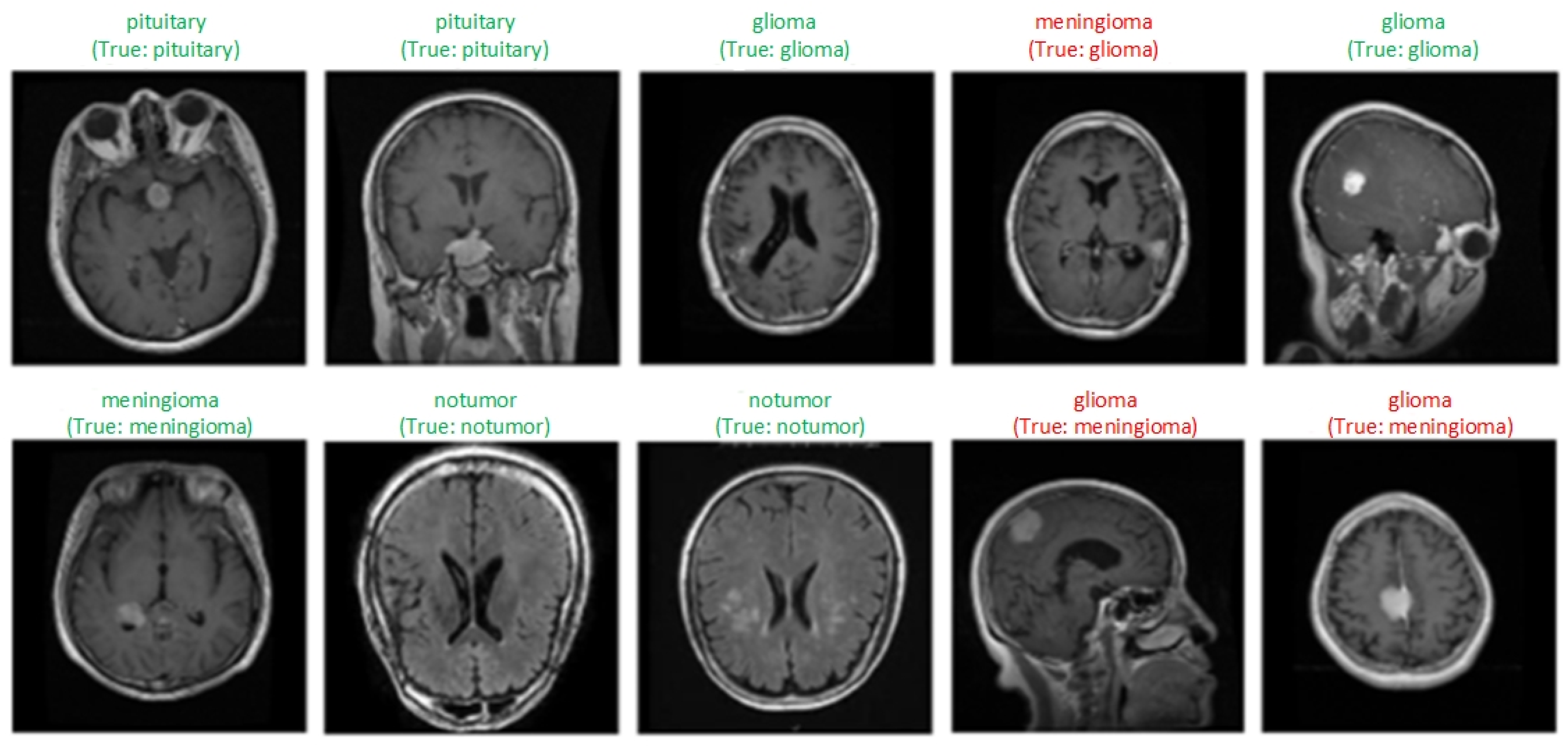 A Novel Hybrid Deep Learning Model Enhanced with Explainable AI for Brain Tumor Multi ...
