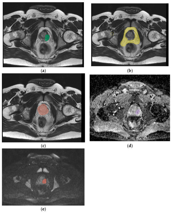 Lymph Node Involvement Prediction Using Machine Learning: Analysis of ...