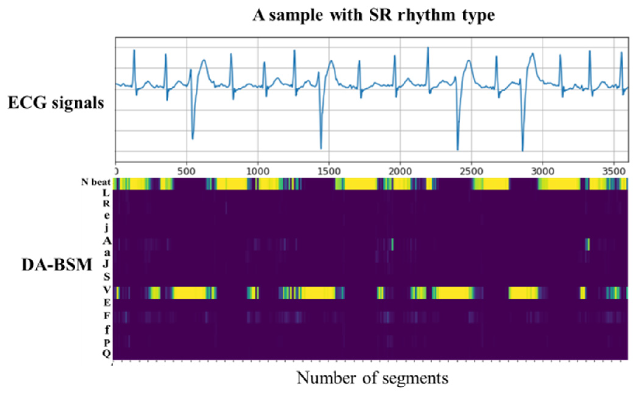 Cross-Database Learning Framework for Electrocardiogram Arrhythmia Classification Using Two ...