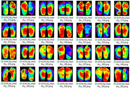 Advanced AI-Driven Thermographic Analysis for Diagnosing Diabetic Peripheral Neuropathy and ...