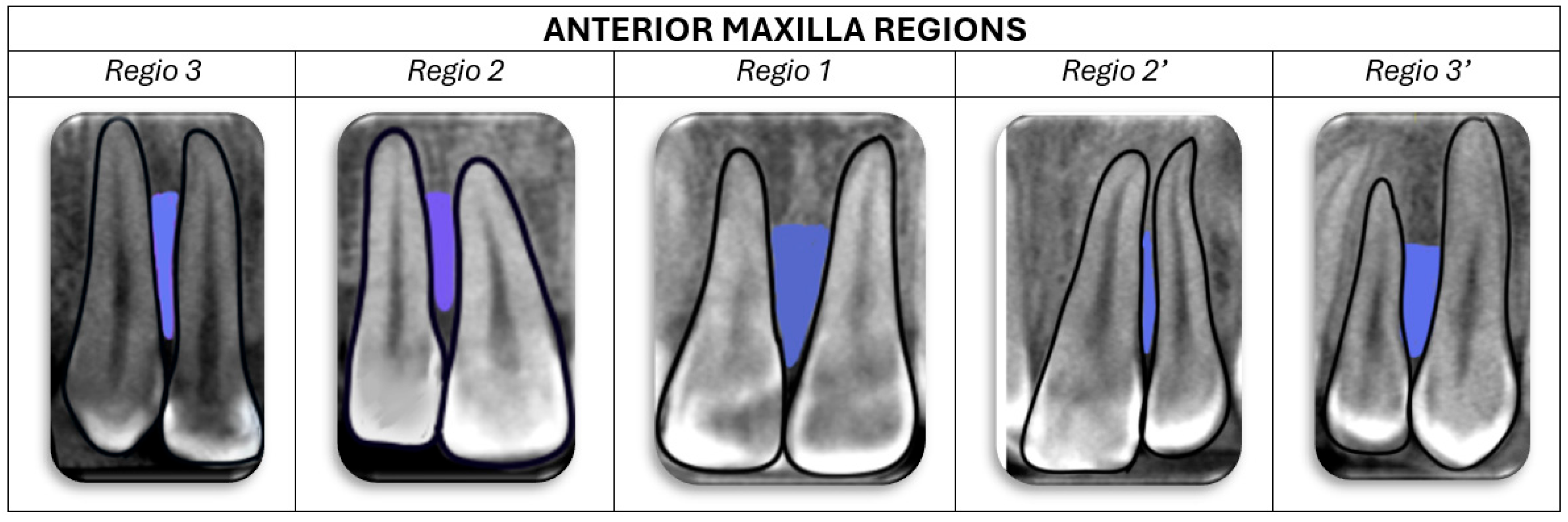 Importance of CBCT Analysis in the Preoperative Planning of TAD ...