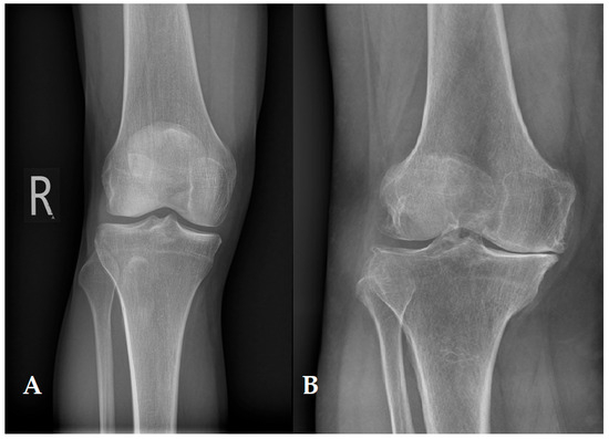 Articular Cartilage: Structure, Biomechanics, and the Potential of ...