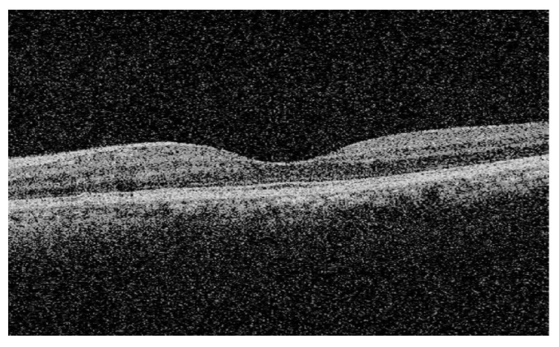 Retinal OCT Images: Graph-Based Layer Segmentation and Clinical Validation