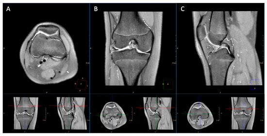Optimizing Knee MRI: Diagnostic Performance of a 3D PDW SPAIR-Based ...