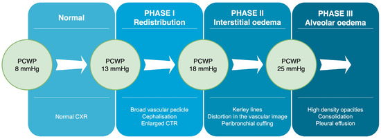 Diagnosing Lung Abnormalities Related to Heart Failure in Chest ...