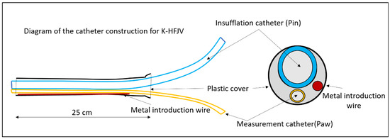 Application and Technical Principles of Catheter High-Frequency Jet ...
