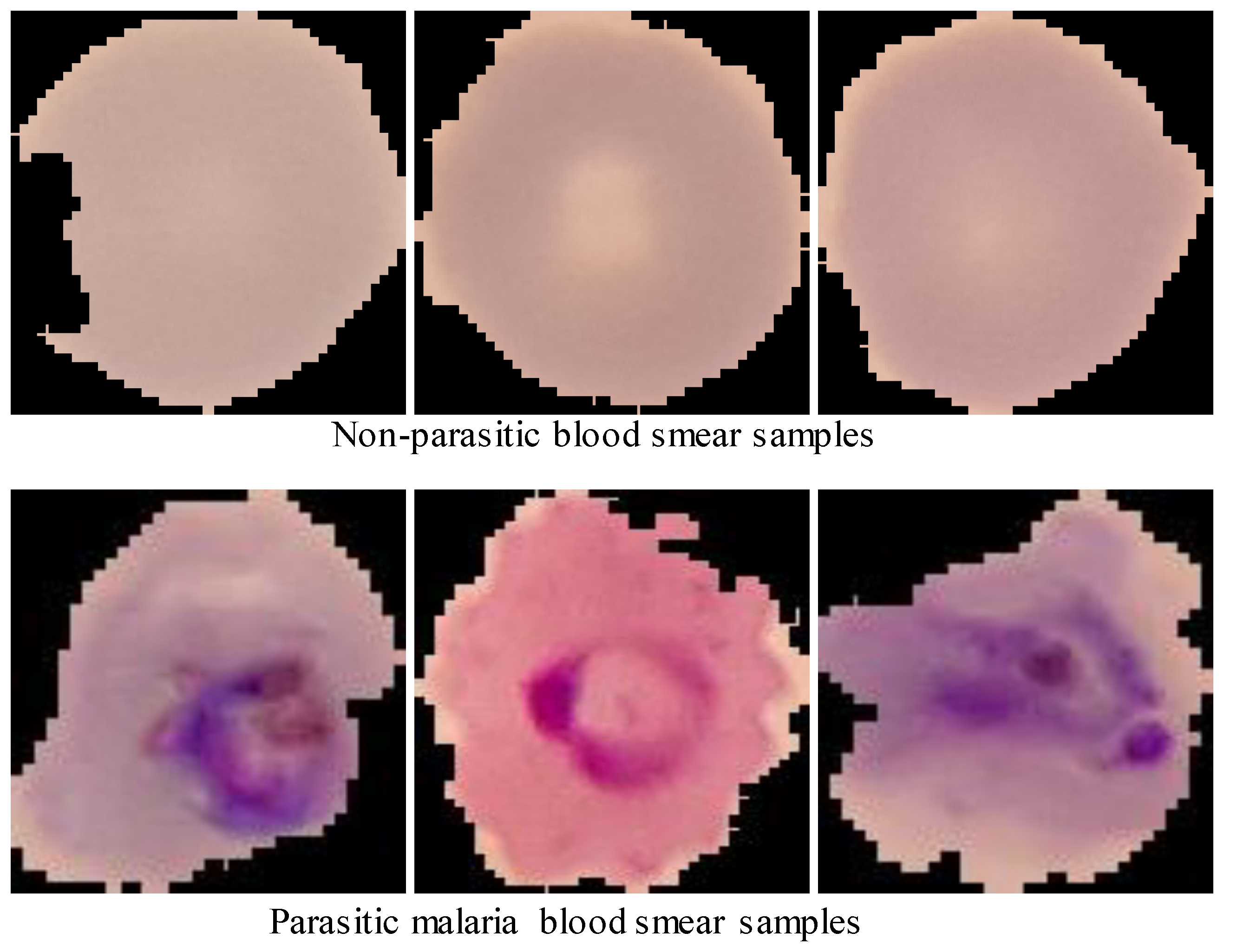 DeepFMD: Computational Analysis for Malaria Detection in Blood-Smear ...