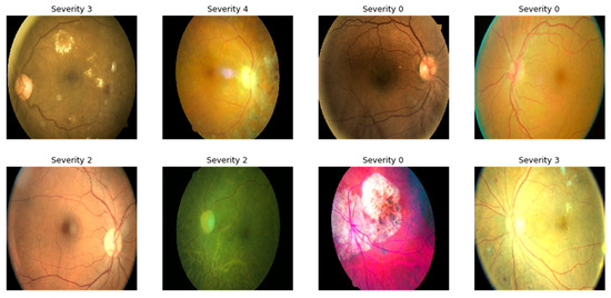 Hybrid Framework for Diabetic Retinopathy Stage Measurement Using Convolutional Neural Network ...