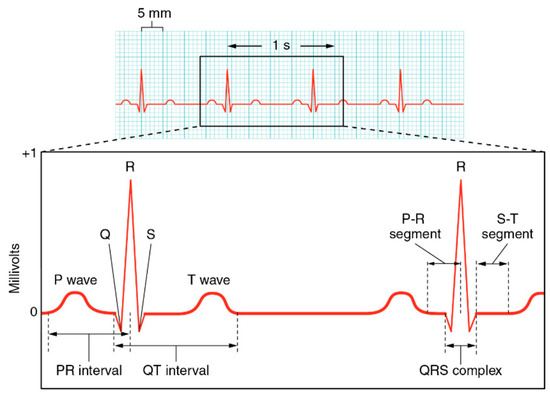AI-Enabled Electrocardiogram Analysis for Disease Diagnosis
