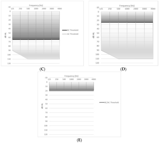 Review of Bone Conduction Hearing Devices