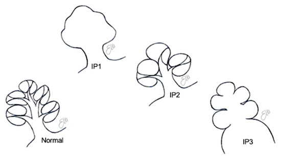 Genetics of Inner Ear Malformations: A Review