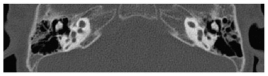 Genetics of Inner Ear Malformations: A Review