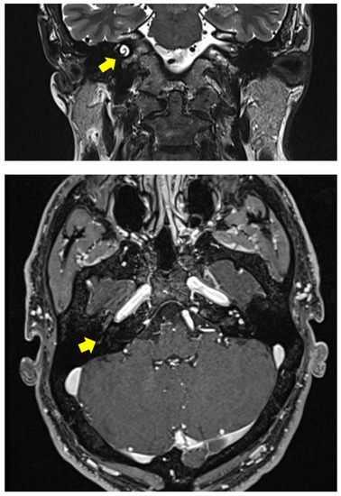 Cochlear Implant in Patients with Intralabyrinthine Schwannoma without ...