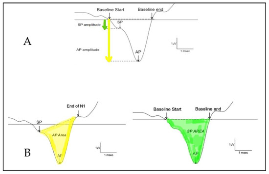 Vestibular Migraine versus Méniere’s Disease: Diagnostic Utility of ...
