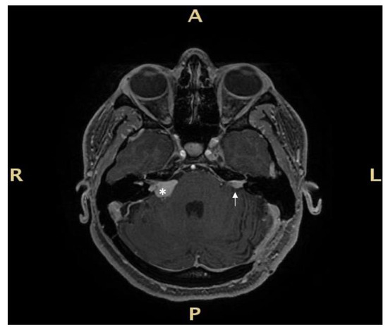 Cochlear Implantation in Intralabyrinthine Schwannoma: Case Series and ...