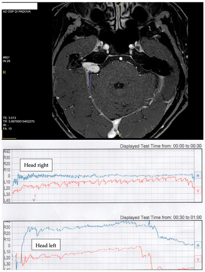 Paroxysmal Positional Nystagmus in Acoustic Neuroma Patients