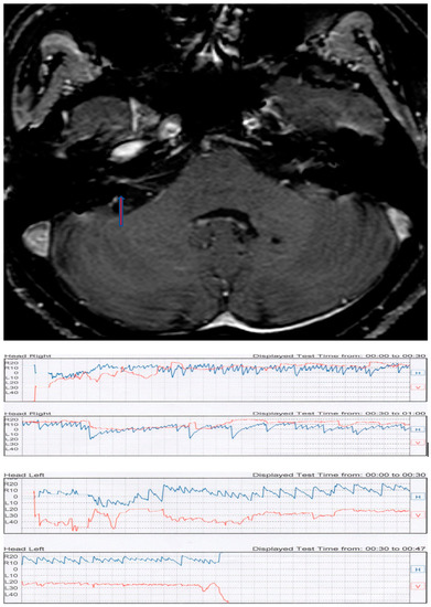 Paroxysmal Positional Nystagmus in Acoustic Neuroma Patients