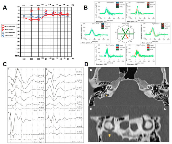 Posterior Semicircular Canal Dehiscence with Vestibulo-Ocular Reflex ...