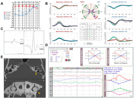 Posterior Semicircular Canal Dehiscence with Vestibulo-Ocular Reflex ...